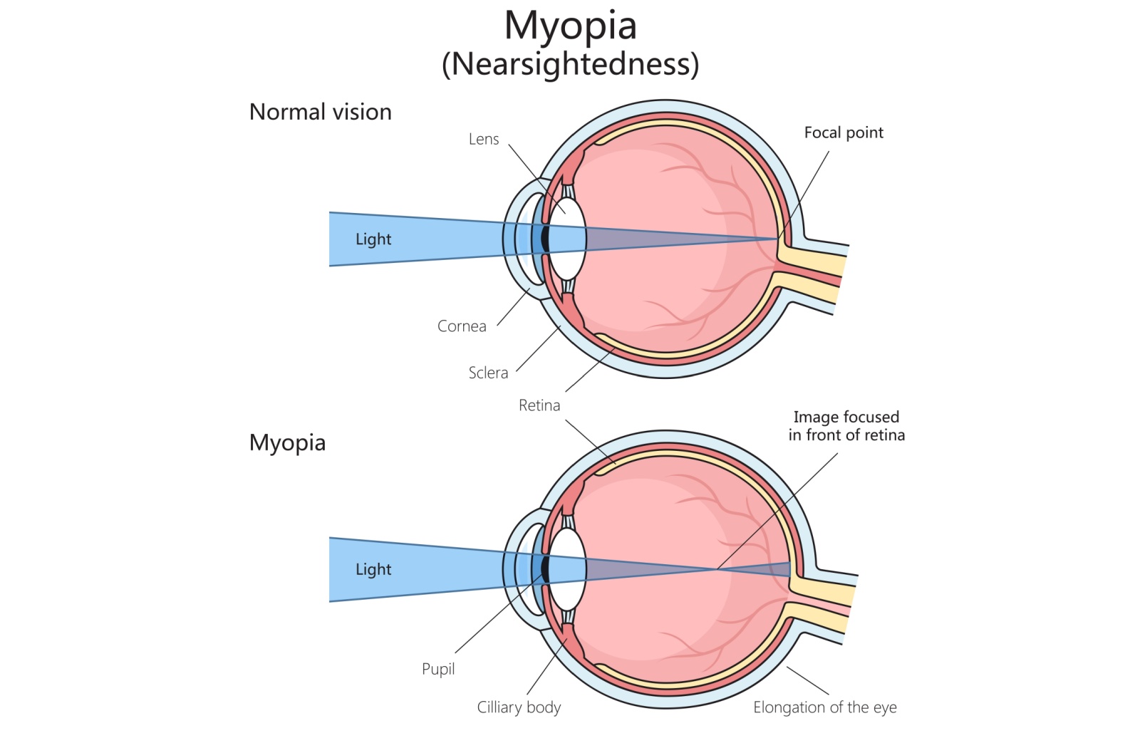 Astigmatism vs. Myopia: What's the Difference?